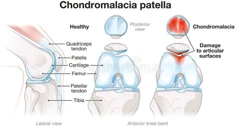 Chondromalacia Patellae Grad 4 Chondropathie Grad 4 Behandlung Uijh