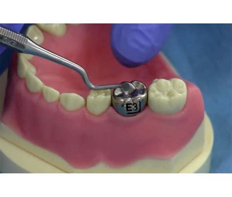 Tooth Preparation For Stainless Steel Crown Step By Step Odontovida