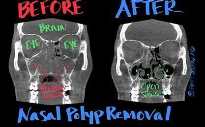 Do I Have Nasal Polyps What Do They Look Like Nasal Polyp Ent