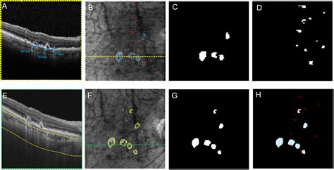 En Face Oct Better Than B Scan In Diagnosis Of Early Macular Atrophy In Amd