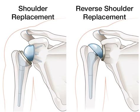 Shoulder Surgery Glacial Ridge Health System