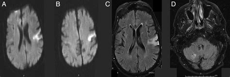 Unilateral Opercular Infarction Presenting With Foix Chavany Marie