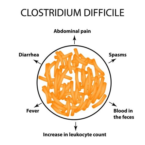 19 En La Categoría Clostridium Difficile Symptoms De Fotos E Imágenes