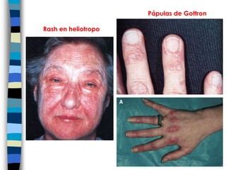 Dermatomiositis Pptx