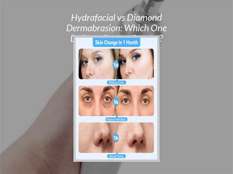 Hydrafacial Diamond Dermabrasion Vs Microderm Real Glow Test Update