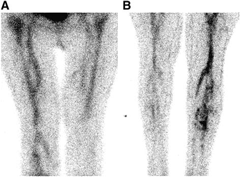 Deep Vein Thrombosis Dvt A Deadly Condition That Can Kill Quickly What