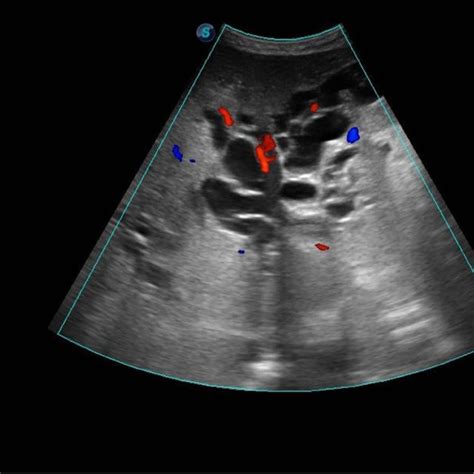Colour Doppler Shows Dilated Intrahepatic Biliary Tree More On Left