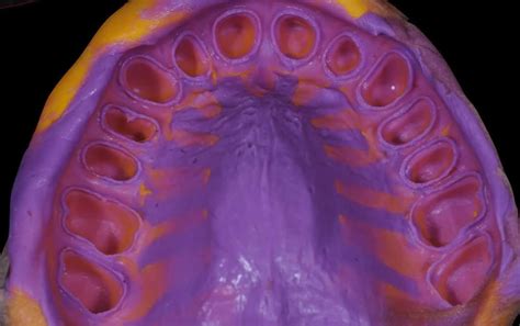 Materiales Para Impresion Impresiones Dentales