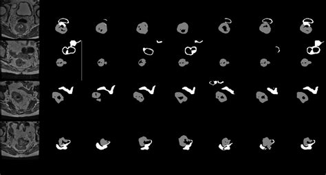 Visualization Of The Rectal Cancers And Rectal Walls Segmentation
