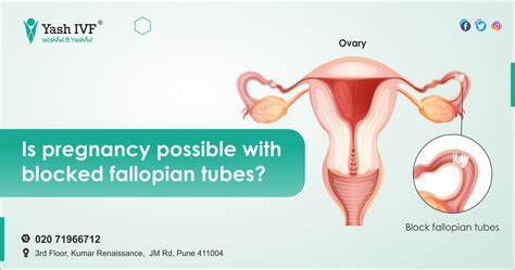 Is Pregnancy Possible With Blocked Fallopian Tubes Yash Ivf
