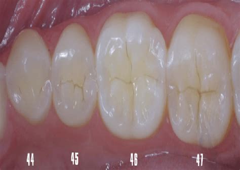 Simulation Of The Restoration Of The Teeth 46 With Pigmentation Of