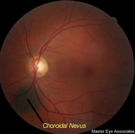 Choroidal Nevus A Common Eye Condition That Can Become Lethal