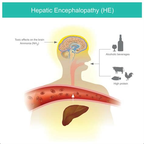 Hepatic Encephalopathy Causes Risk Factors Symptoms Treatment