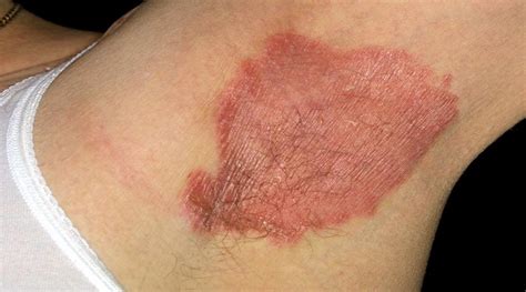 Psoriasis Treatment In Pune Skin Rash Treatment In Kothrud