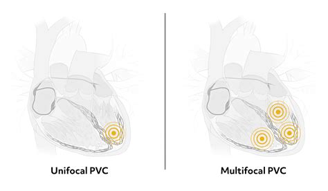 What Causes Multifocal Pvcs