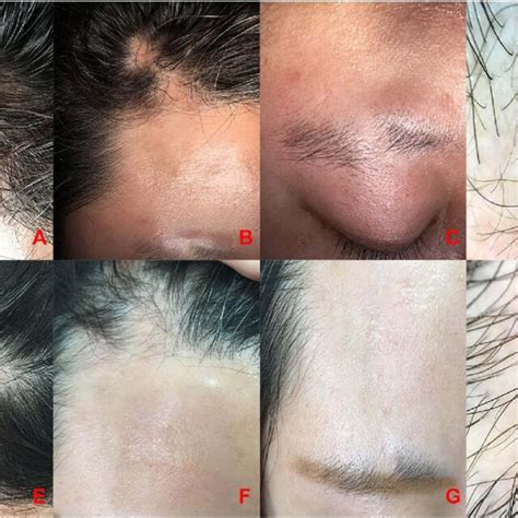 Clinical And Dermoscopy Findings A Atrophic Linear Patch Of Alopecia Download Scientific