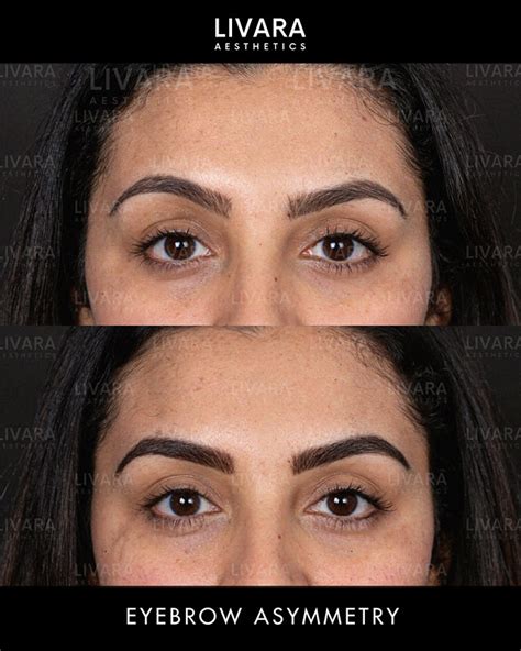 Fix Eyebrow Asymmetry Fix Uneven Eyebrows Botox Options Livara