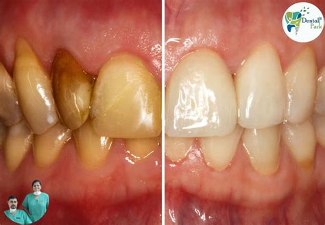 Dental Plaque Removal