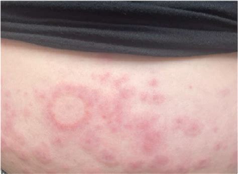 Targetoid Rash On Lower Abdomen Download Scientific Diagram