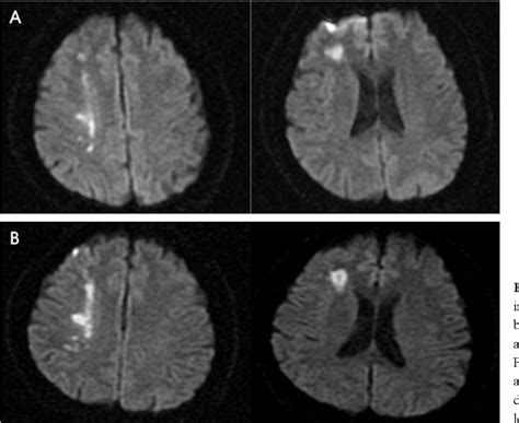 Figure 1 From A Case Of Emergency Extracranial Intracranial Arterial Bypass Surgery For Acute
