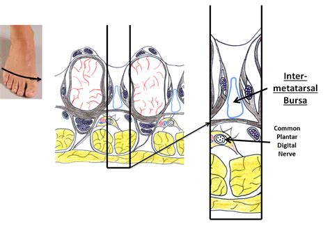 Intermetatarsal Bursitis Ankle Foot And Orthotic Centre