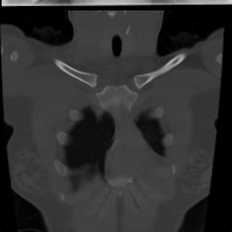 A Serendipity View Of The Scj Showing A Posterior Scj Dislocation B Download Scientific