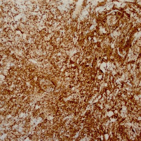 Immunostaining Reveals Monomorphic Atypical Lymphocytes Diffusely