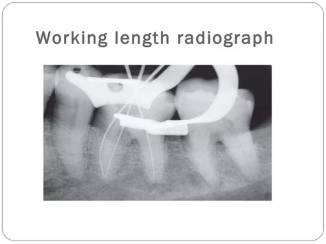 Obturation Techniques Ppt