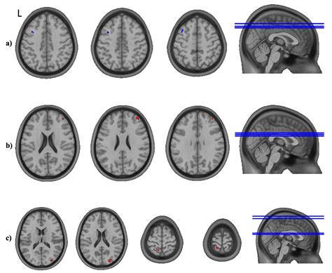 Orbitofrontal Cortex Mri