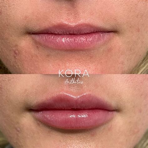 Before And After Lip Fillers Photo Gallery Witness Transformation