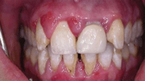 The Transition From Paediatric Diabetes Services To Adult Care