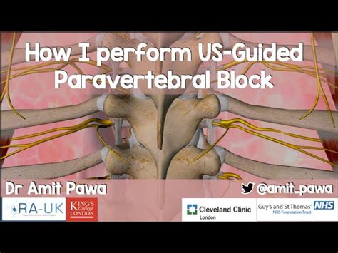 Paravertebral Block