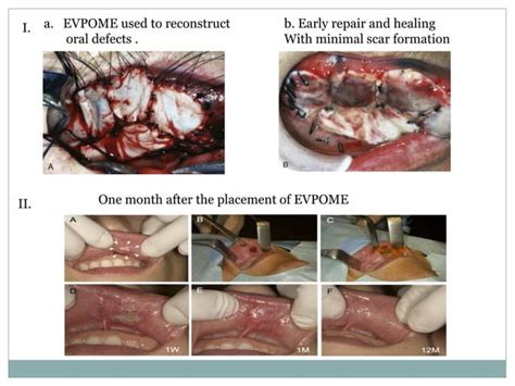Oral Mucosal Tissue Engineering Pptx Dental Health Diseases And