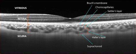 1 Anatomy Of The Choroid The Choroid Consists Of Five Layers