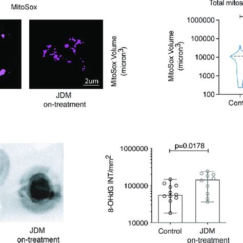 There Is Enhanced Oxidative Stress In Jdm Cd14 Monocytes Which Is