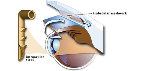 Fda Approves First Glaucoma Stent For Use With Cataract Surgery Medlatest