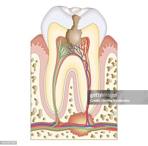 Tooth Abscess Photos And Premium High Res Pictures Getty Images