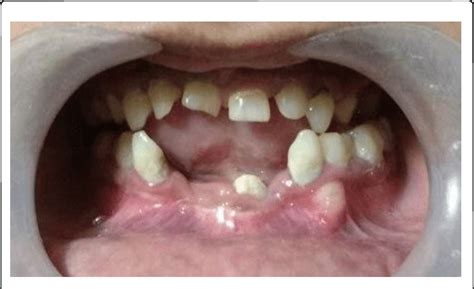 Intra Oral View Of The Patient With Retained Deciduous Teeth In Mouth