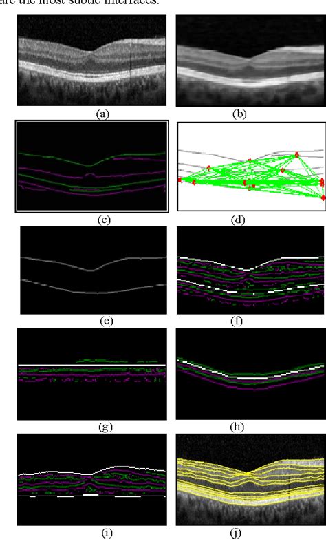 Figure 1 From Intra Retinal Layers Segmentation Of Macular Oct Images