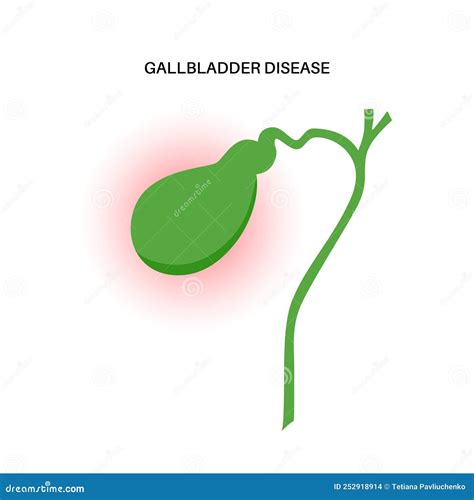 Gallbladder Disease Poster Stock Vector Illustration Of Organ 252918914
