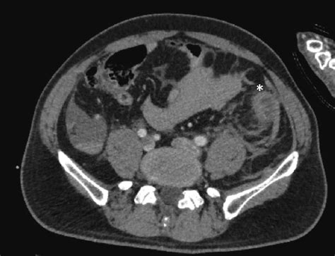 A Case Of Traumatic Mesenteric Bleeding In Which Emergent Surgery Could Be Avoided By