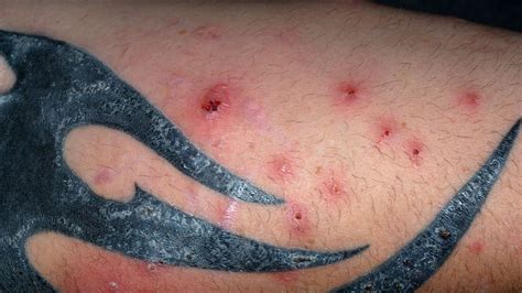 Signs Of Staph Aureus Skin Infection Eczema 101 Virtual Grand Rounds