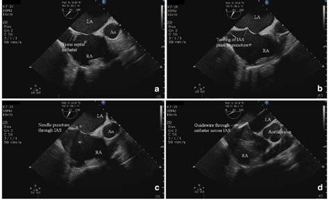 Tee Guided Trans Septal Puncture For Catheter Based Cardiac Procedures