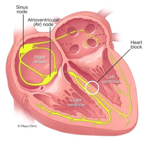 Left Bundle Branch Block Ecg