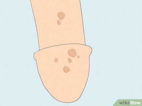 Warts Symptoms Men