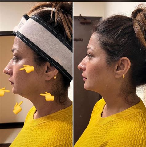 Dr Akshara Shaji On Linkedin Happypatient Patienttransformation Fillertransformation