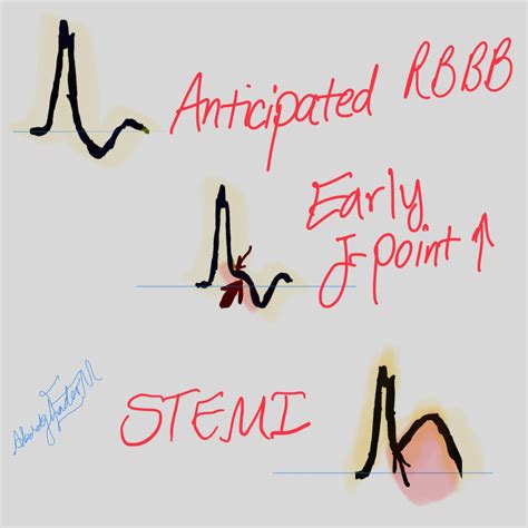 Understanding Right Bundle Branch Block Key Ecg Insights