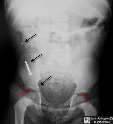 Learning Radiology Lead Poisoning Plumbism Intoxication Ingestion