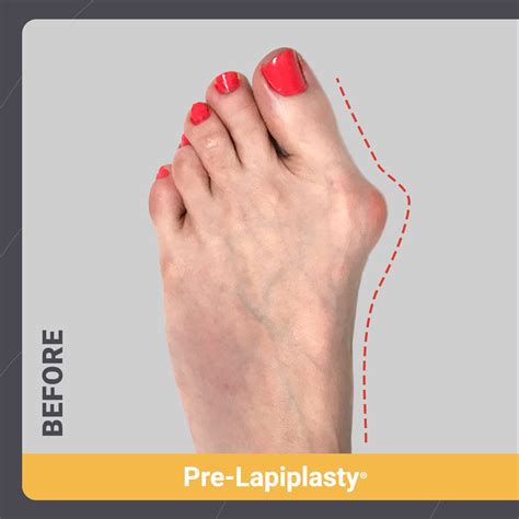 Treace Medical Concepts Inc On Linkedin Lapiplasty Beforeandafter