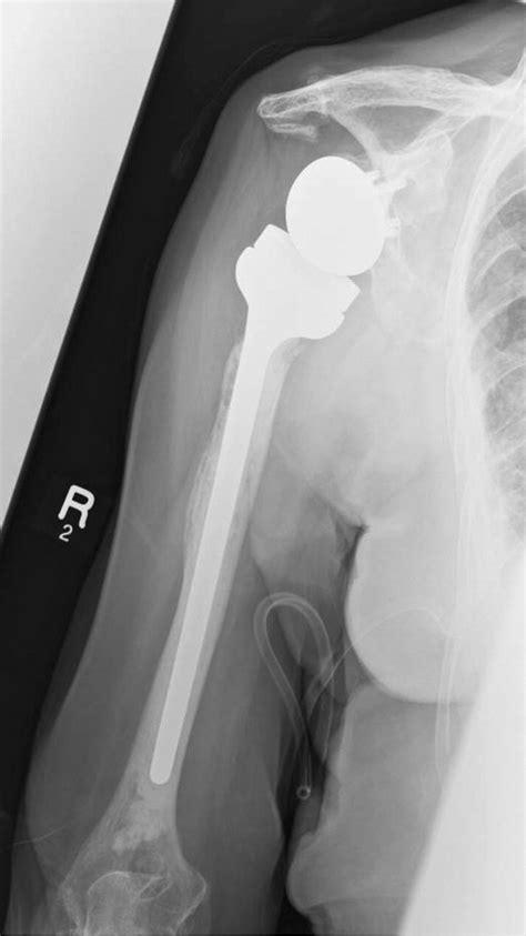 Reverse Geometry Shoulder Replacement For Proximal Humeral Metastases